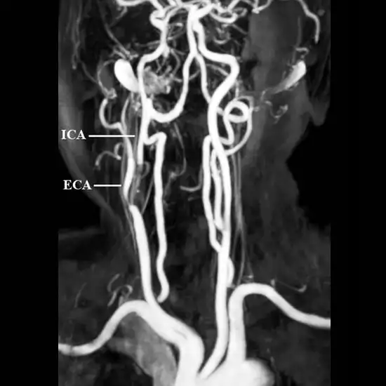 MR Angiography of Ascending Arch of Aorta | Test Price In Delhi, India ...