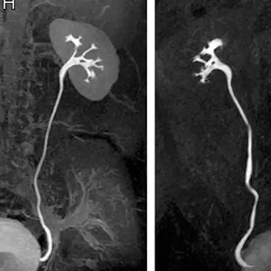 MRI Kub Region Test Near You in Delhi | Book Test at Low Price