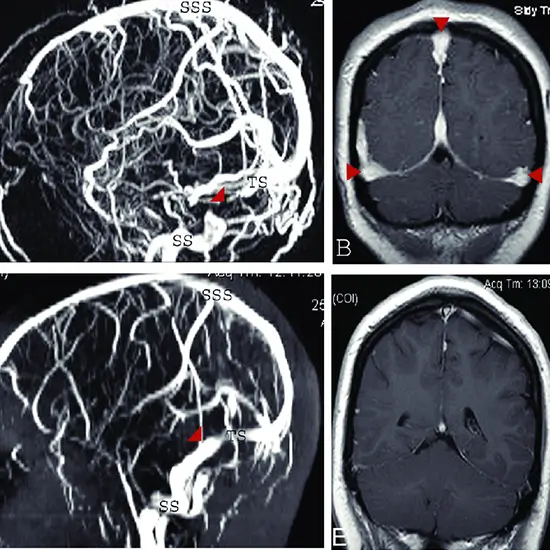 MRI Venography Test Near You in Delhi | Book Test at Low Price