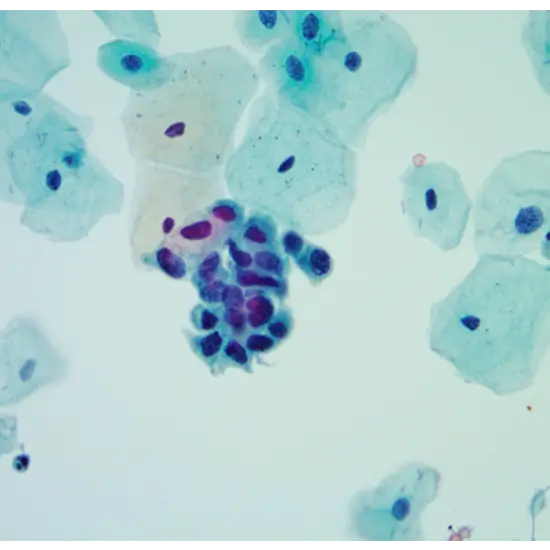 Urine For Cytology | Test Price in Delhi | Ganesh Diagnostic