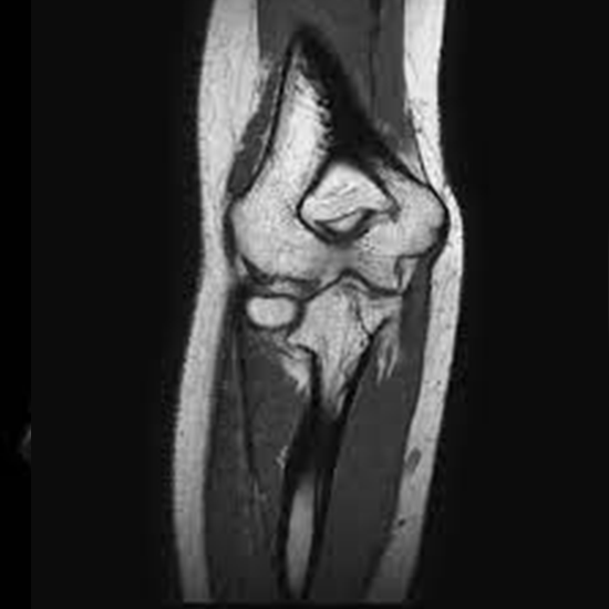 MRI Right Elbow Joint | Test Price in Delhi | Ganesh Diagnostic