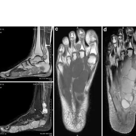 MRI Right Foot With Contrast | Test Price In Delhi, India | Ganesh ...