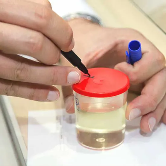 Protein Electrophoresis 24 Hour Urine | Test Cost In Delhi, India ...