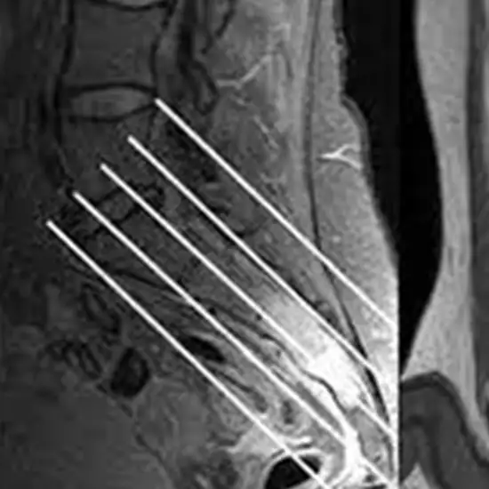 MRI Sacrum Coccyx Joint | Test Price in Delhi | Ganesh Diagnostic