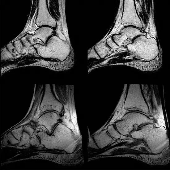 MRI Screening Right Foot Joint Price In Delhi, India | Ganesh Diagnostic
