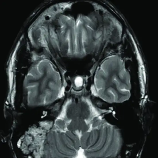 MRI Screening Temporal Bone | Test Price in Delhi | Ganesh Diagnostic