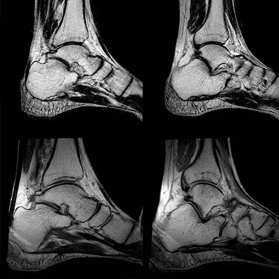 MRI Screening of Left Foot Test Near You in Delhi | Book Test at Low Price