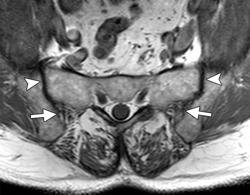 MRI Screening Of SI Joint | Test Price in Delhi | Ganesh Diagnostic