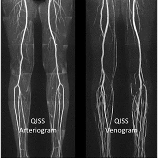 MRI Angiography Lower Limb Test Near You in Delhi | Book Test at Low Price