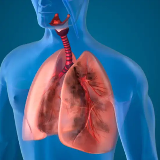 Autoimmune Interstitial Lung Disease | Test Price In Delhi, India ...