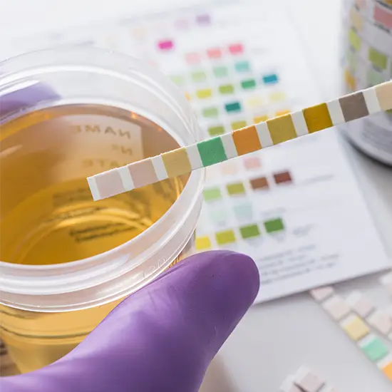 Methamphetamine Screen, Urine | Test Price In Delhi, India | Ganesh ...