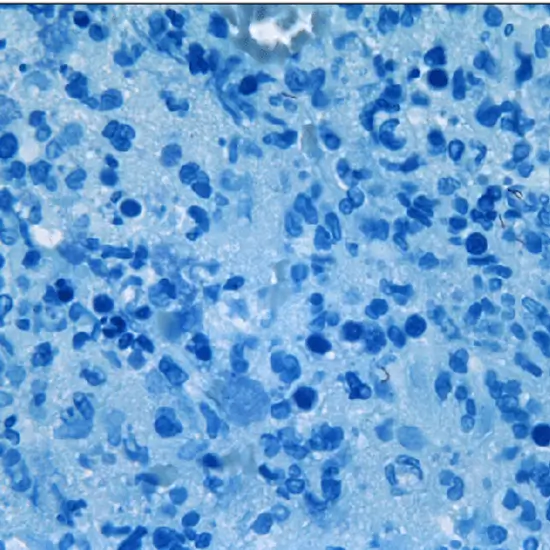 Biopsy With AFB Stain | Test Price In Delhi, India | Ganesh Diagnostic