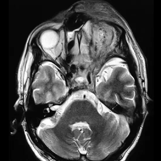 MRI Face And Orbit | Test Price in Delhi | Ganesh Diagnostic