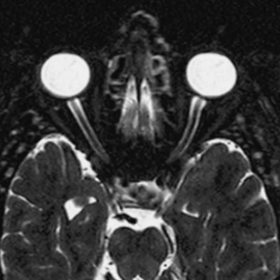 MRI Eye | Test Price in Delhi | Ganesh Diagnostic