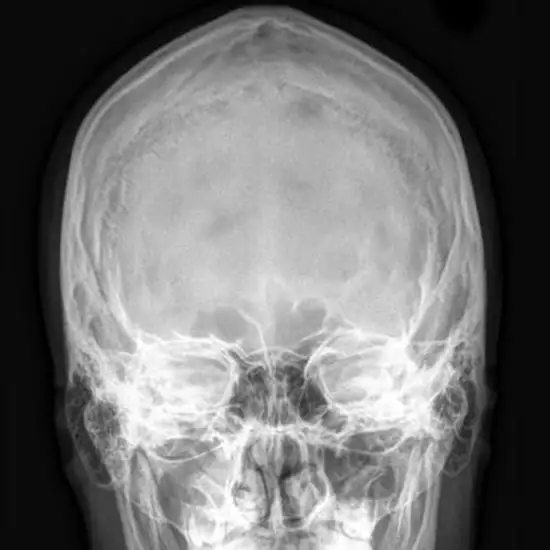 X-ray Mandible AP/Lateral | Test Price in Delhi | Ganesh Diagnostic