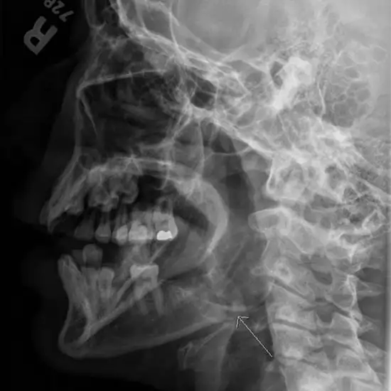 X-ray Mandible Left Lateral Oblique | Test Price in Delhi | Ganesh ...