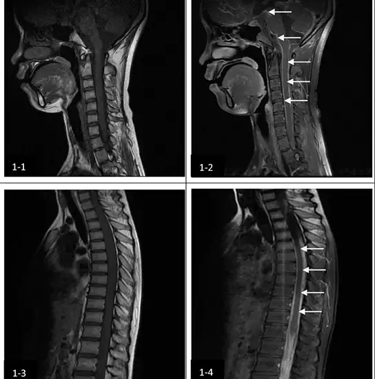 MRI Medulla Plain | Test Price in Delhi | Ganesh Diagnostic