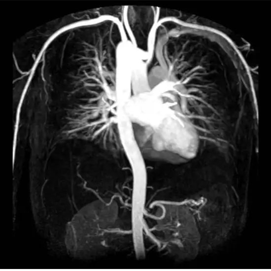 MR Angiography Chest Scan Test Near You in Delhi | Book Test at Low Price