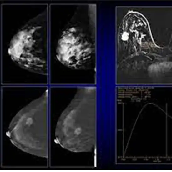 Book MRI Mammography Scan | Test Price In Delhi | Ganesh Diagnostic