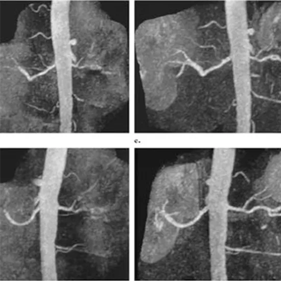 MR Angiography Abdominal Aorta With Contrast Scan Test Near You in ...