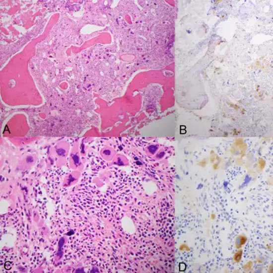 CALR Mutation Detection Cost in Delhi Test Price Near Me, India | GDIC