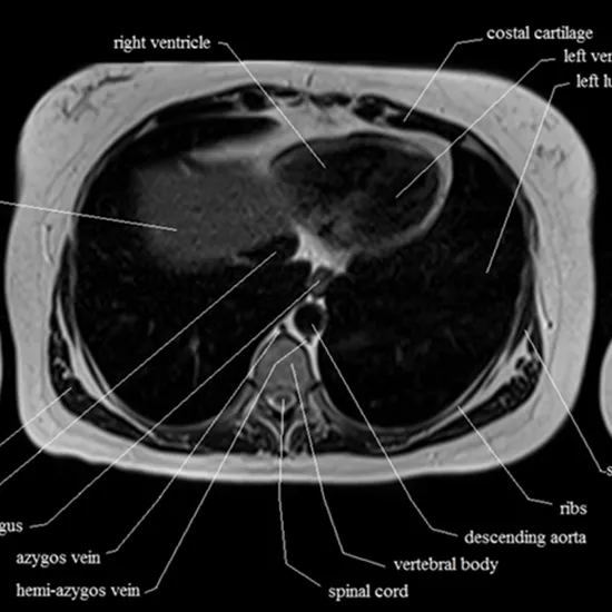 MRI Thorax | Test Price in Delhi | Ganesh Diagnostic