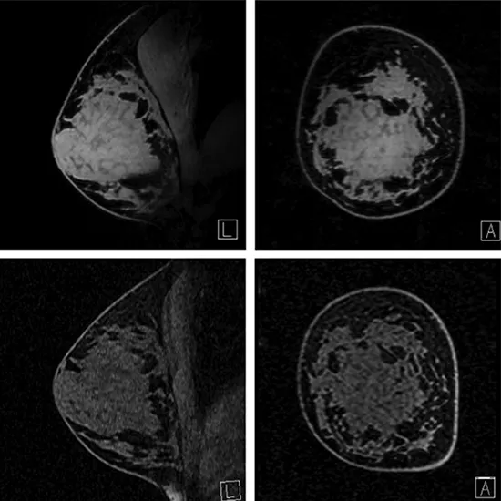 MRI Mammography and Spectroscopy | Test Price in Delhi | Ganesh Diagnostic