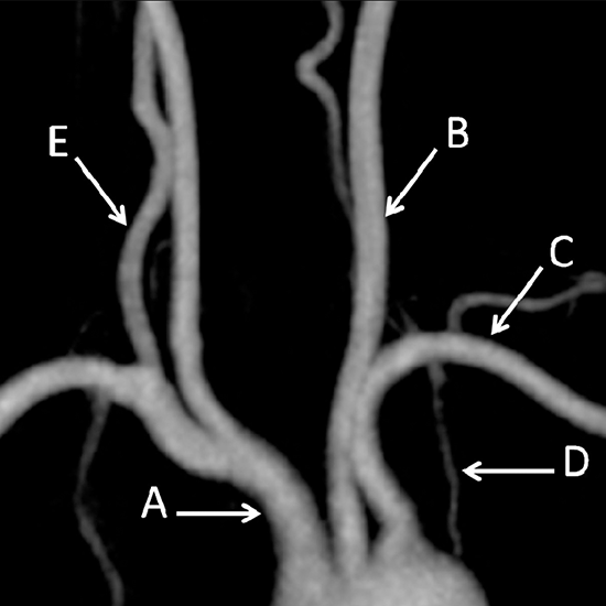 MR Angiography Aortic Arch | Test Price in Delhi | Ganesh Diagnostic