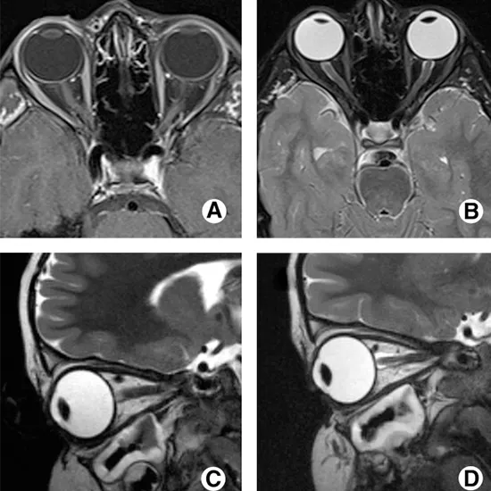 MRI Screening Of Eye | Test Price in Delhi | Ganesh Diagnostic