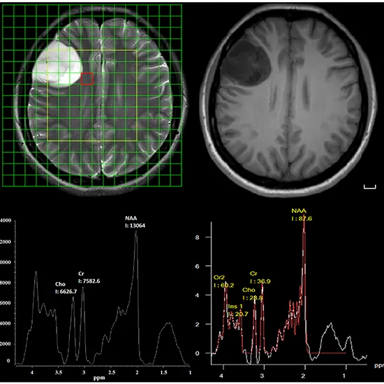 MRI 3D Multivoxel Spectroscopy | Test Price in Delhi | Ganesh Diagnostic