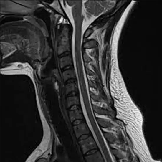MRI Cervical Spine With Contrast Test Near You in Delhi | Book Test at ...