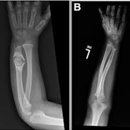 MRI Left Forearm | Test Price in Delhi | Ganesh Diagnostic