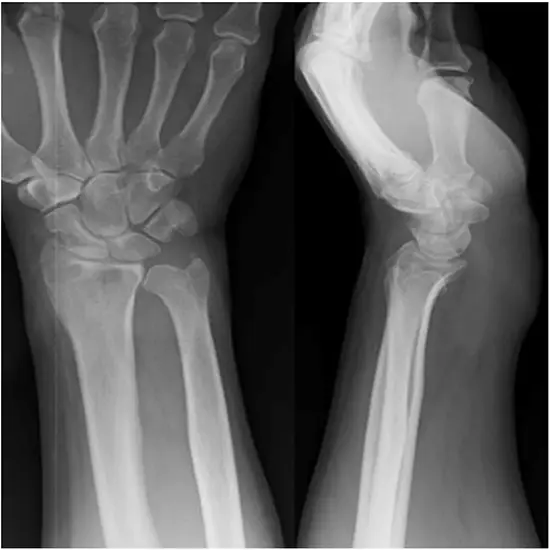 X-ray Left Wrist AP Lateral | Test Price in Delhi | Ganesh Diagnostic
