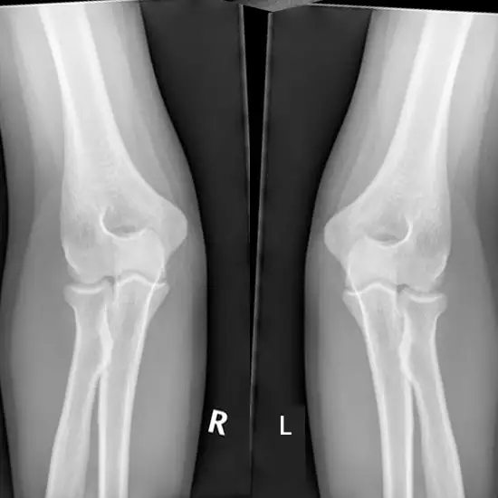 X Ray Elbow Joint Elbow X Ray Hi Res Stock Photography And Images