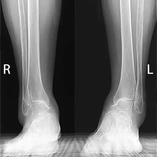 X Ray Ankle Ap Foot, Ankle, And Calf | Radiology Key