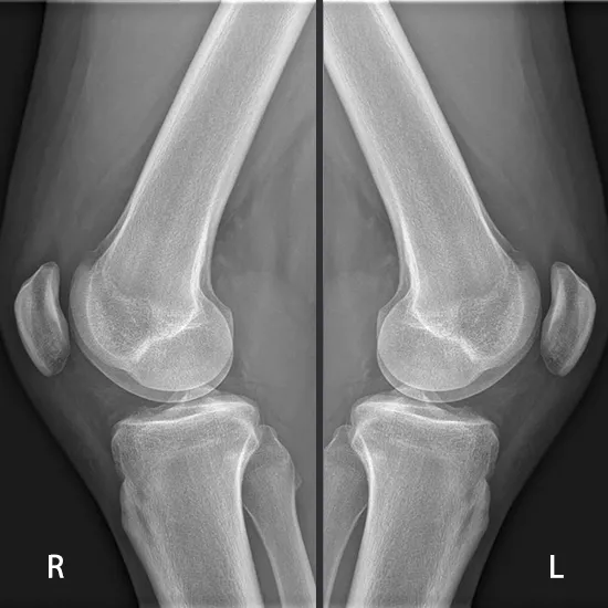 X-ray Both Knee LAT View | Test Price in Delhi | Ganesh Diagnostic