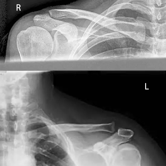 X-ray Clavicle Both AP | Test Price in Delhi | Ganesh Diagnostic