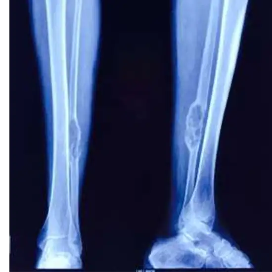 X-ray Left Leg AP View | Test Price in Delhi | Ganesh Diagnostic