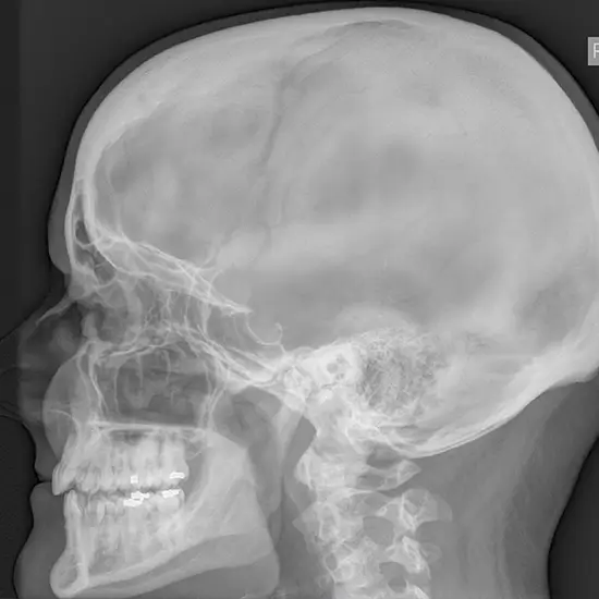 X-Ray Left Mastoid LAT/Oblique | Test Price in Delhi | Ganesh Diagnostic