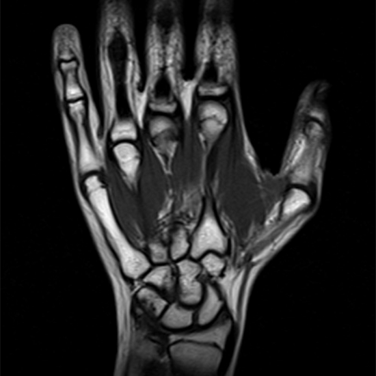 MRI Left Hand | Test Price in Delhi | Ganesh Diagnostic