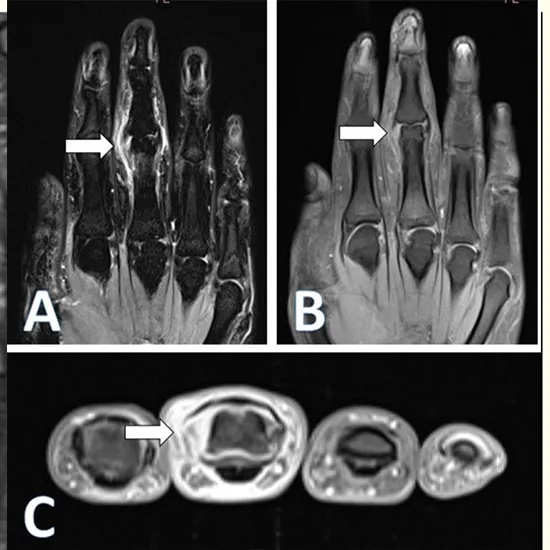 MRI Right Finger Price In Delhi Right Finger Test Cost Near Me, India ...