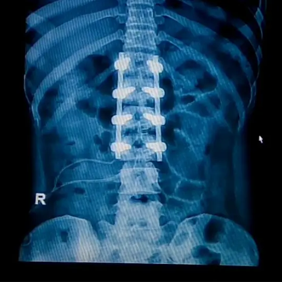 X-ray Dorsal Lumber AP/LAT/Extension/Flexion | Test Price in Delhi