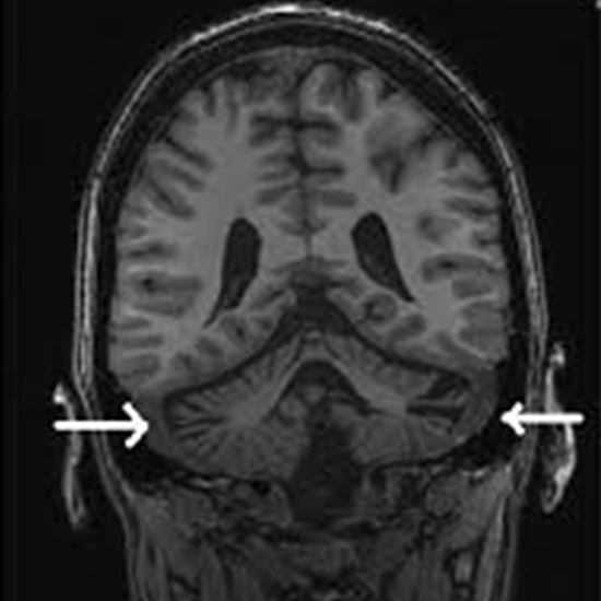 Book Episodic Ataxia Comprehensive Profile | Test Price In Delhi ...