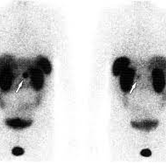 Octreotide Scan | Test Price In Delhi | Cost Near Me, India | Ganesh ...