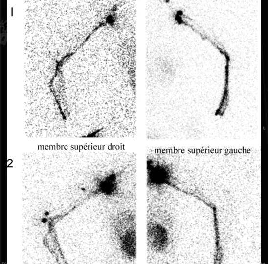 Lymphoscintigraphy (Part-1) | Test Price In Delhi | Cost Near Me, India ...