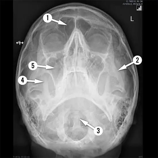DMSA (Dimercaptosuccinic Acid) Renal Cortical Scintigraphy Test ...