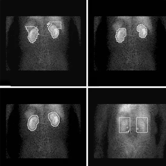 DTPA Renogram With GFR | Test Price In Delhi | Cost Near Me, India ...
