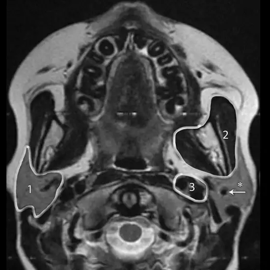 MRI Left Parotid Region | Test Price in Delhi | Ganesh Diagnostic