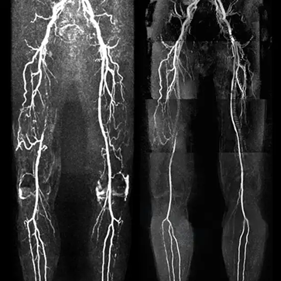 MR Angiography Left Lower Limb With Contrast Test Near You in Delhi ...