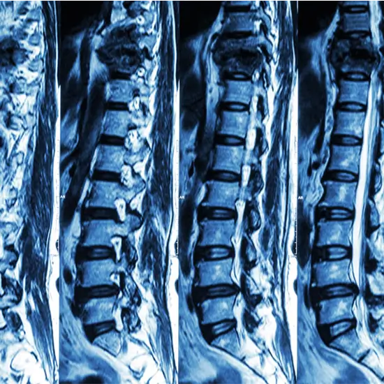 MRI Lumber Sacral (LS) Spine | Test Price in Delhi | Ganesh Diagnostic